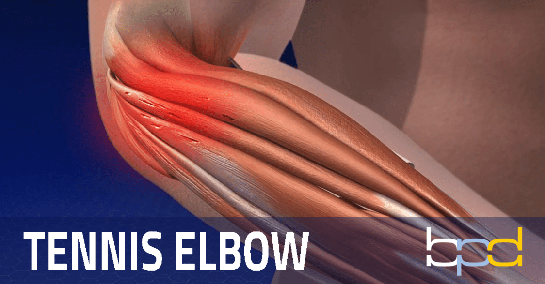 Treating Tennis Elbow: 4 Tips You Can Use - Brandon P. Donnelly, MD
