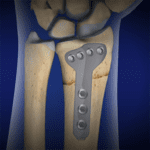 Open Surgery for Wrist Fractures - Brandon P. Donnelly, MD