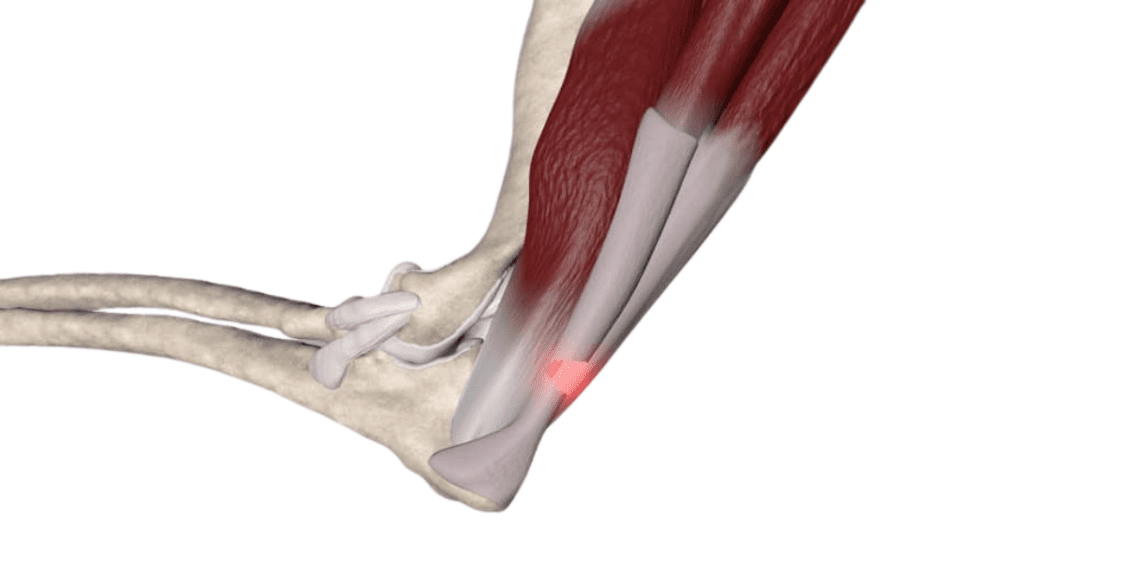 Triceps Tendon Tear - Brandon P. Donnelly, MD