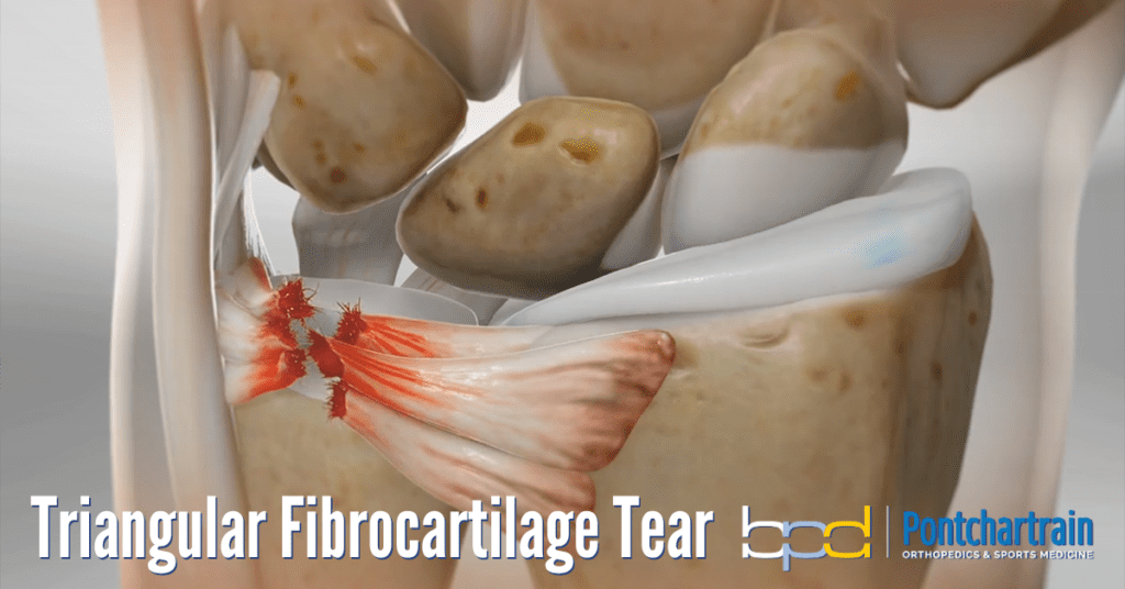 Triangular Fibrocartilage Tear - Brandon P. Donnelly, MD